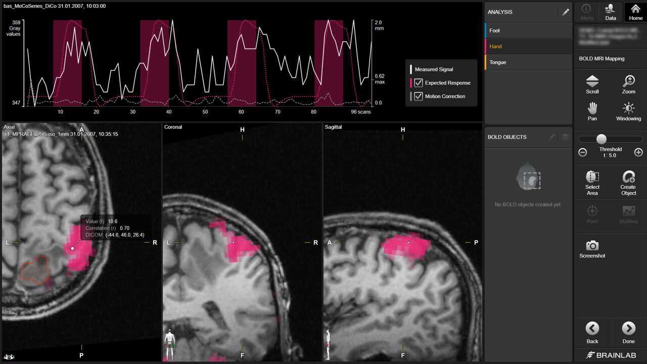 Cranial Planning with Elements: Software for Neurosurgery | Brainlab